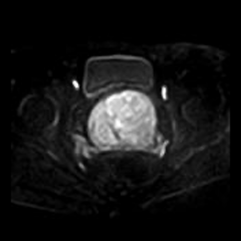 Prostataarterienembolisation (PAE) – wie sieht unser aktueller ...